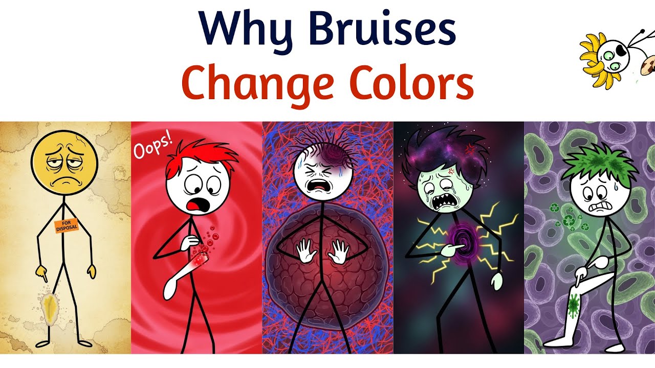 Why Bruises Change Colors - YouTube