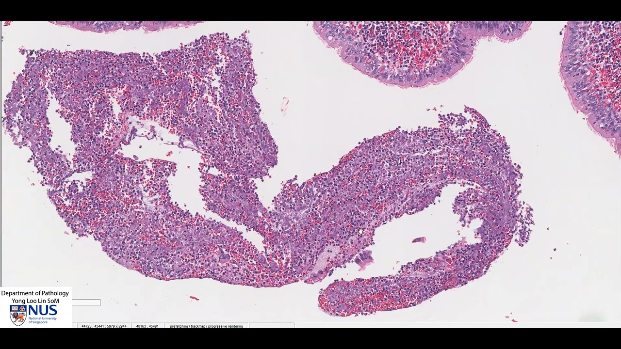 Lung: Bronchiectasis Microscopy - Talking slide - YouTube