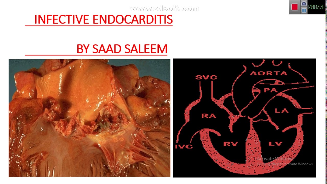 CVS PATHOLOGY | INFECTIVE ENDOCARDITIS | HEART SOUNDS AND MURMURS - YouTube
