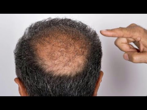 CURE BALDNESS And HOW TO REGROW HAIR NATURALLY without Transplant ...