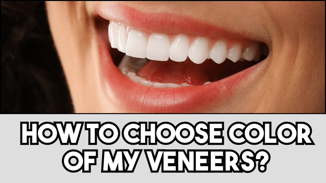 How do i choose the color of my veneers? - YouTube