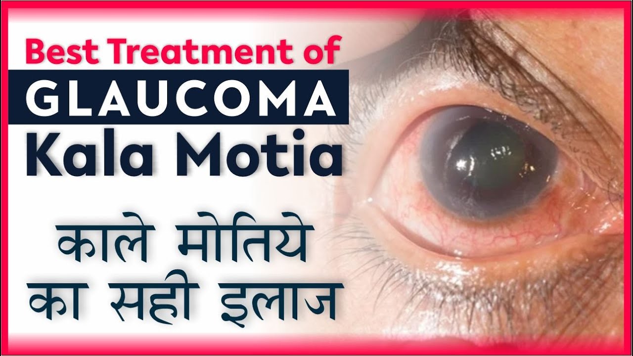Latest Medical Treatment for Glaucoma patients | kala Motia Ka sahih ...