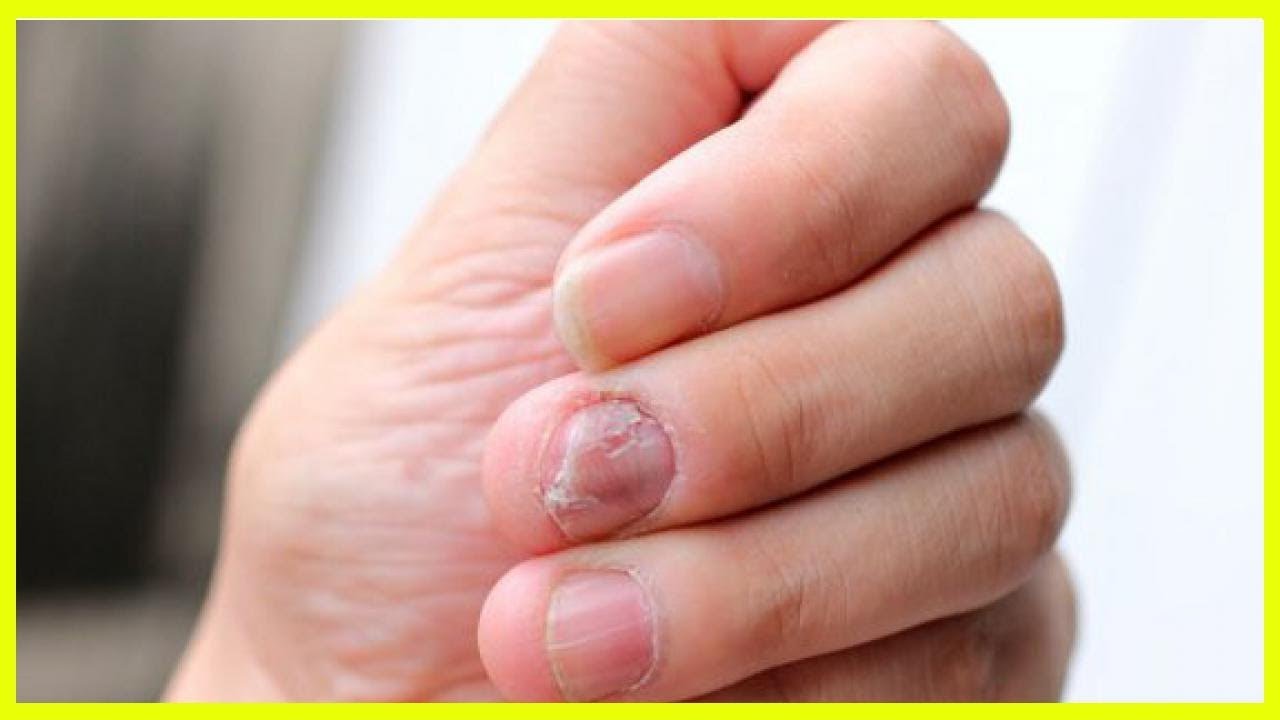 5 remèdes naturels pour lutter contre le psoriasis des ongles - YouTube