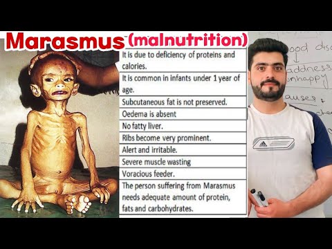 Marasmus | Malnutrition | Deficiency of carbohydrates, lipids and other ...