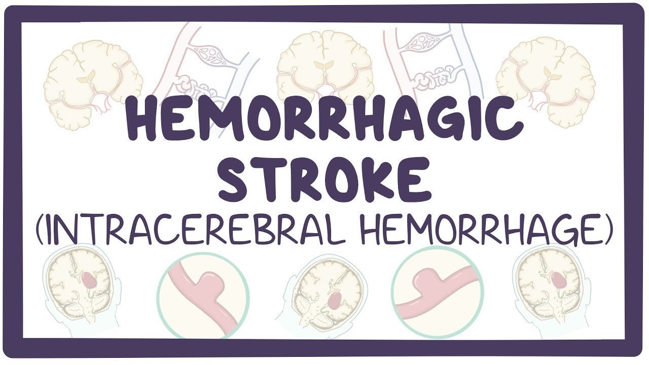 Hemorrhagic Stroke Intracerebral Hemorrhage Causes Symptoms Hemorrhagic Stroke Intracerebral Hemorrhage Causes Symptoms