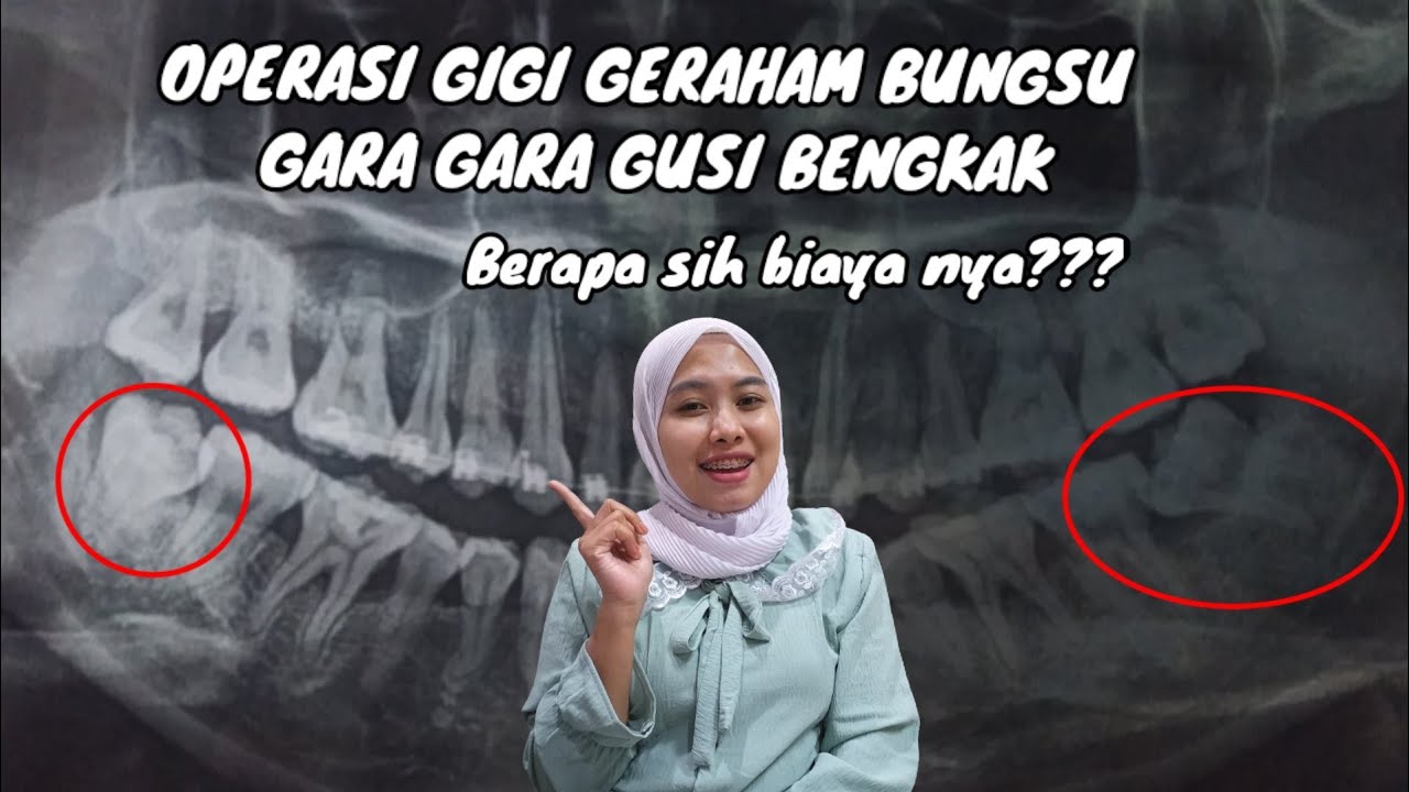 PENGALAMAN OPERASI GIGI GERAHAM BUNGSU TAHUN 2021 #Ikilomila - YouTube