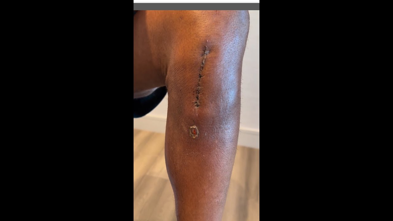 David Goggins: Yet ANOTHER Surgery After Accident!!! | They won't TEACH ...