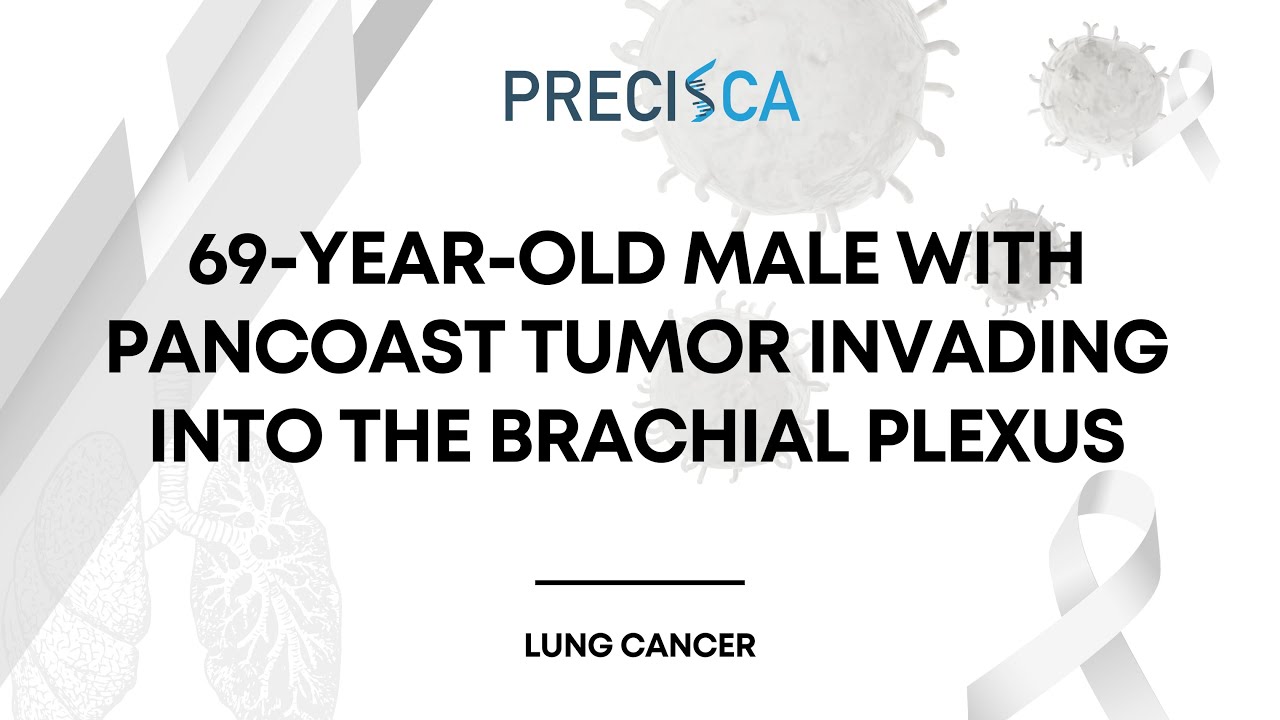Expert Cancer Panel: Pancoast tumor invading into the brachial plexus ...