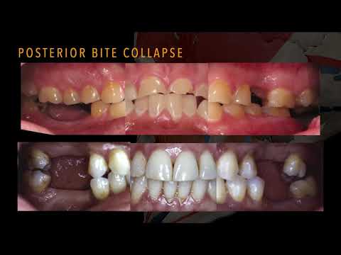 Posterior Bite Collapse and Perio AAP v3 final - YouTube