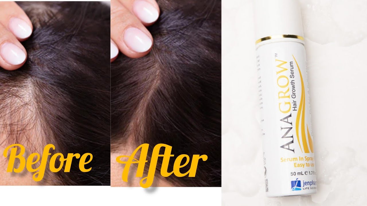 anagrow hair serum... jenpharm best hair fall serum ever| must try ...