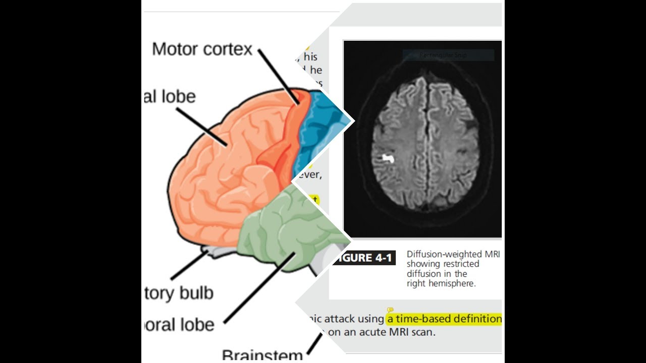 Transient Ischemic Attack (TIA) (with solved clinical cases at the end ...
