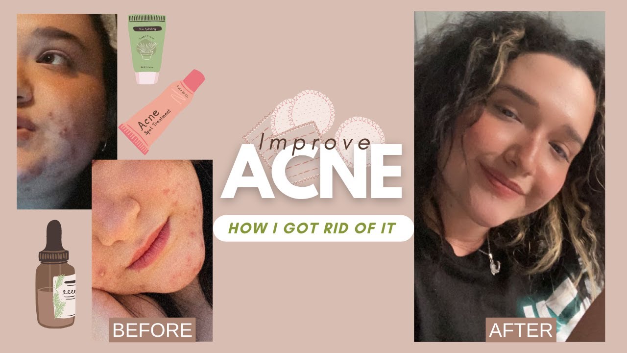 HOW TO GET RID OF ACNE | Improve your Sensitive Skin - YouTube