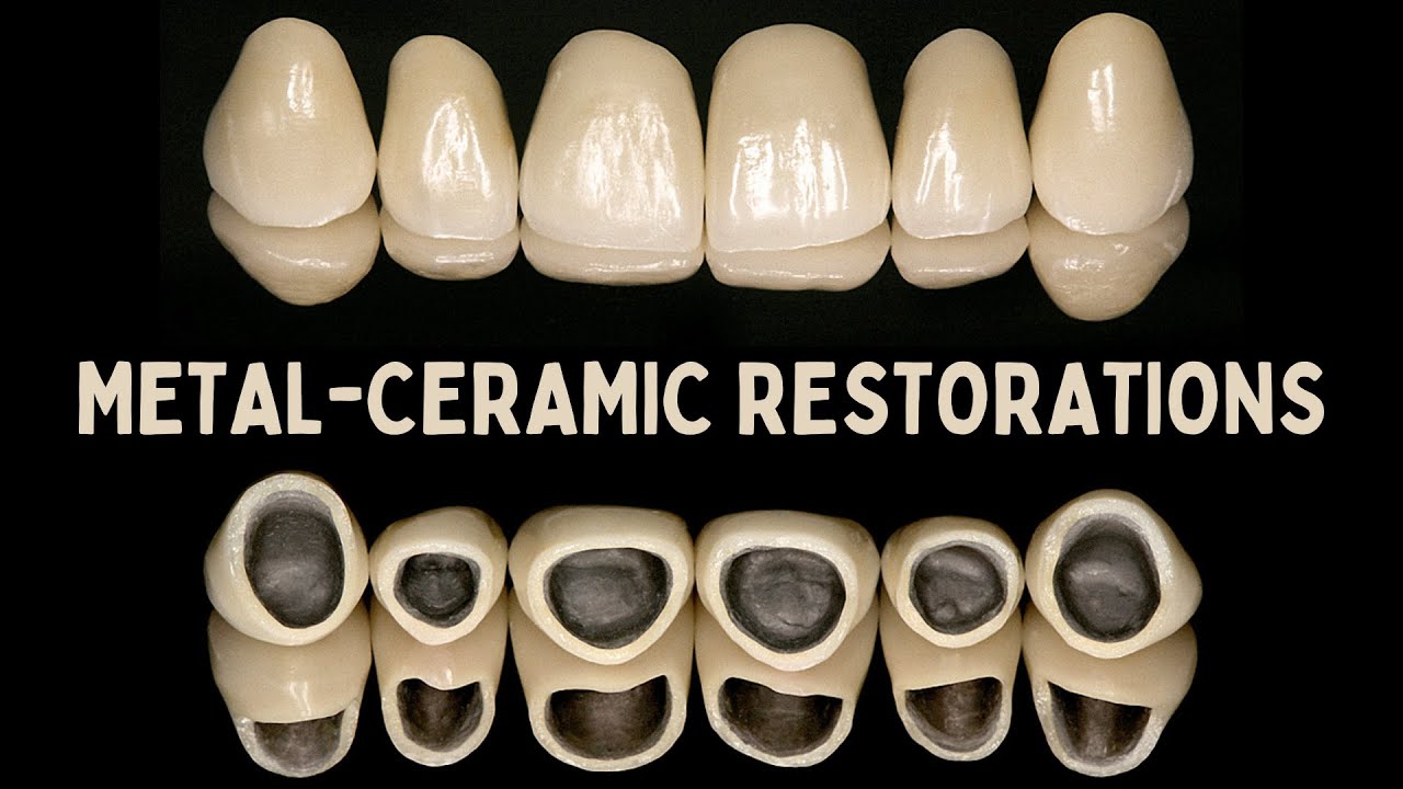 METAL CERAMIC RESTORATIONS - Herbert T. Shillingburg Jr - YouTube