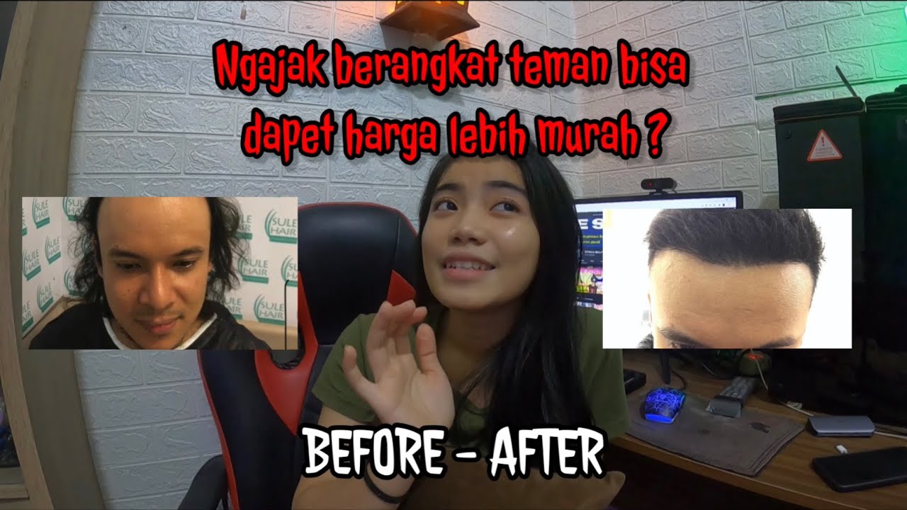 TANAM RAMBUT TURKI / BEFORE AFTER HAIR TRANSPLANTASI - YouTube