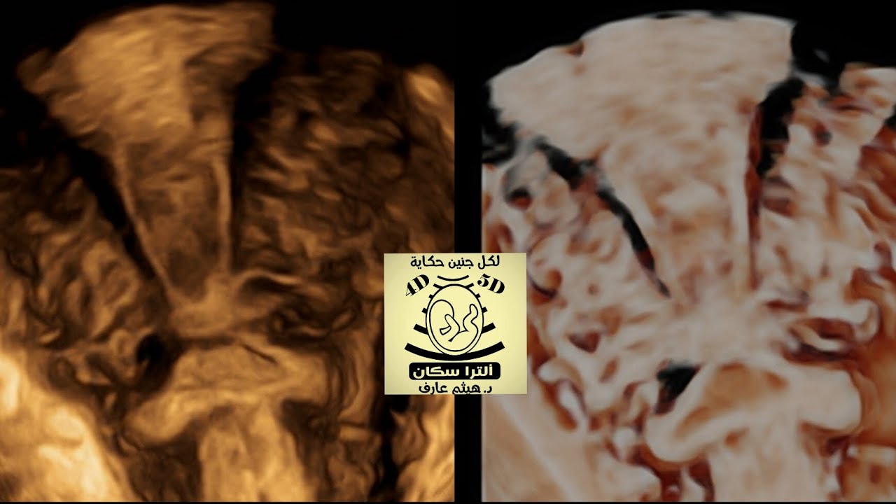 Cs Scar Diverticulum Gynecological Ultrasound Previous 3 Cs Youtube