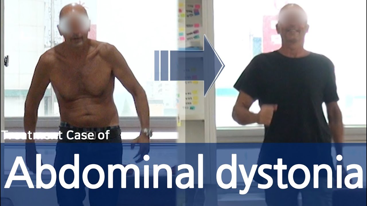 Abdominal wall dystonia / Truncal dystonia / Belly dancer’s dyskinesia ...