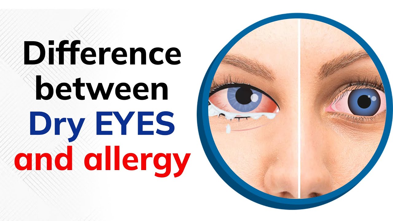 Difference between dry eye and allergy? | Dr. Harpreet Eye & Dental ...