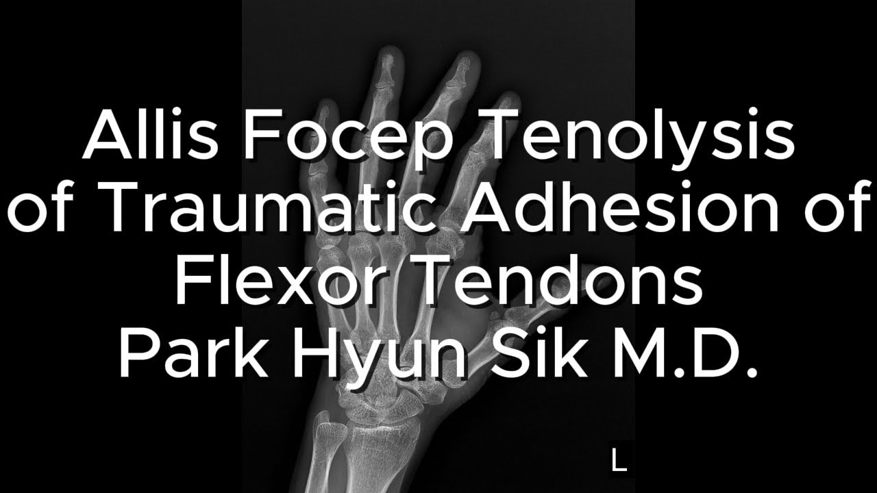 Allis Focep Tenolysis of Traumatic Adhesion of Flexor Tendons - YouTube