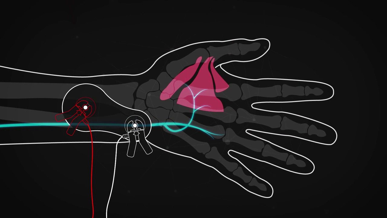 MedTech Stimpod Supramaximal Stimulation in Objective Neuromuscular ...