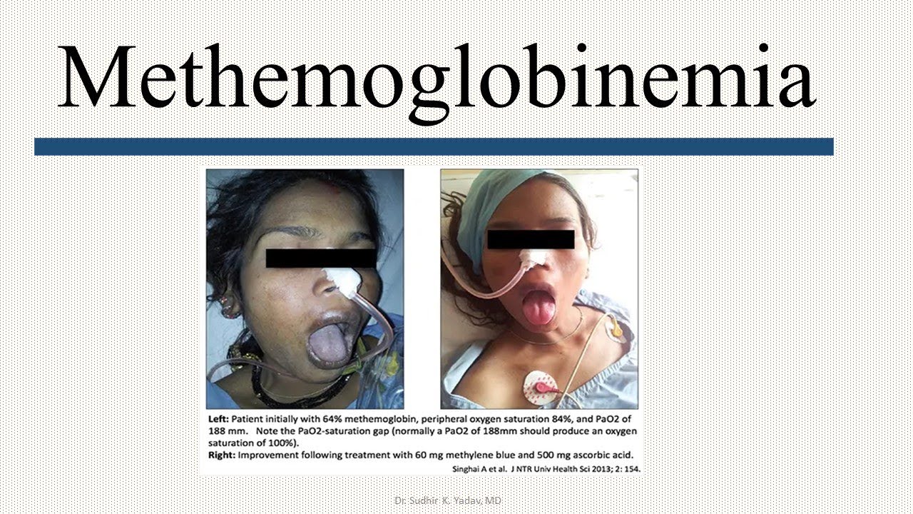 Methamoglobinemia: Medicine Masterclass: Dr. Sudhir K. Yadav,MD - YouTube