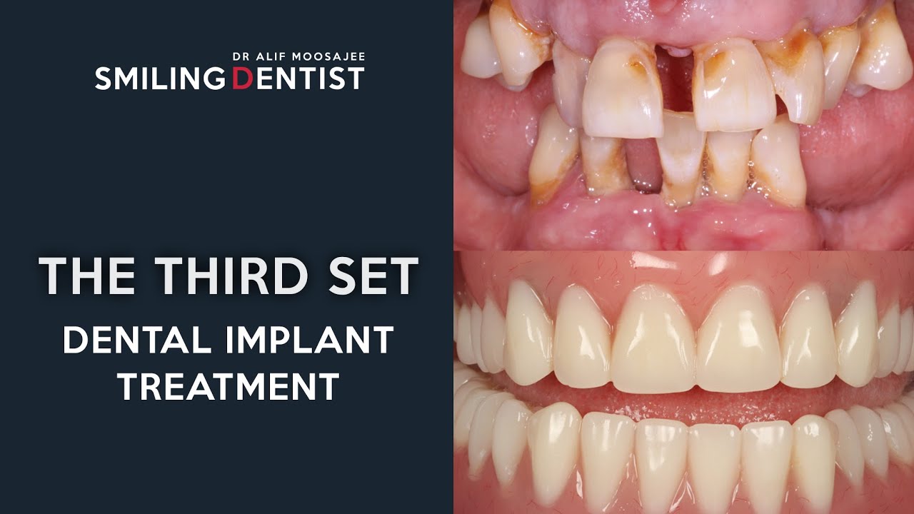 The Third Set - dental implant treatments - YouTube