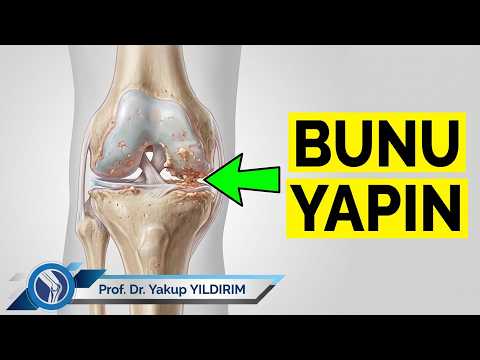 Diz kireçlenmesi ameliyatsız tedavi edilir mi? | Prof. Dr. Yakup YILDIRIM