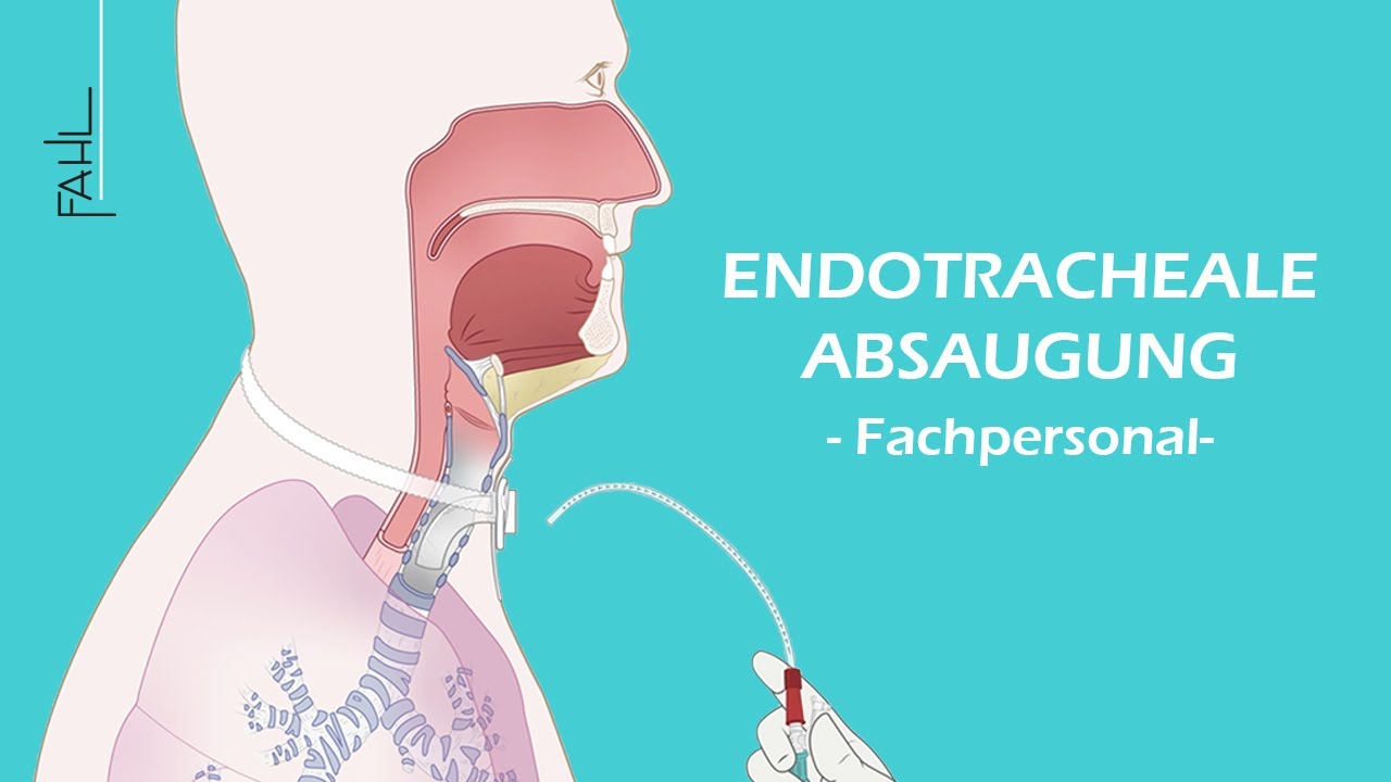 Endotracheale Absaugung für Pflegepersonal | Animation | Fahl ...