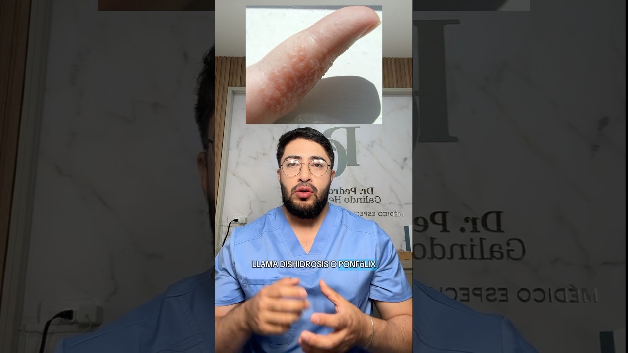 Dishidrosis o ponfólix #skincare #dermatologo #dermatologia # ...