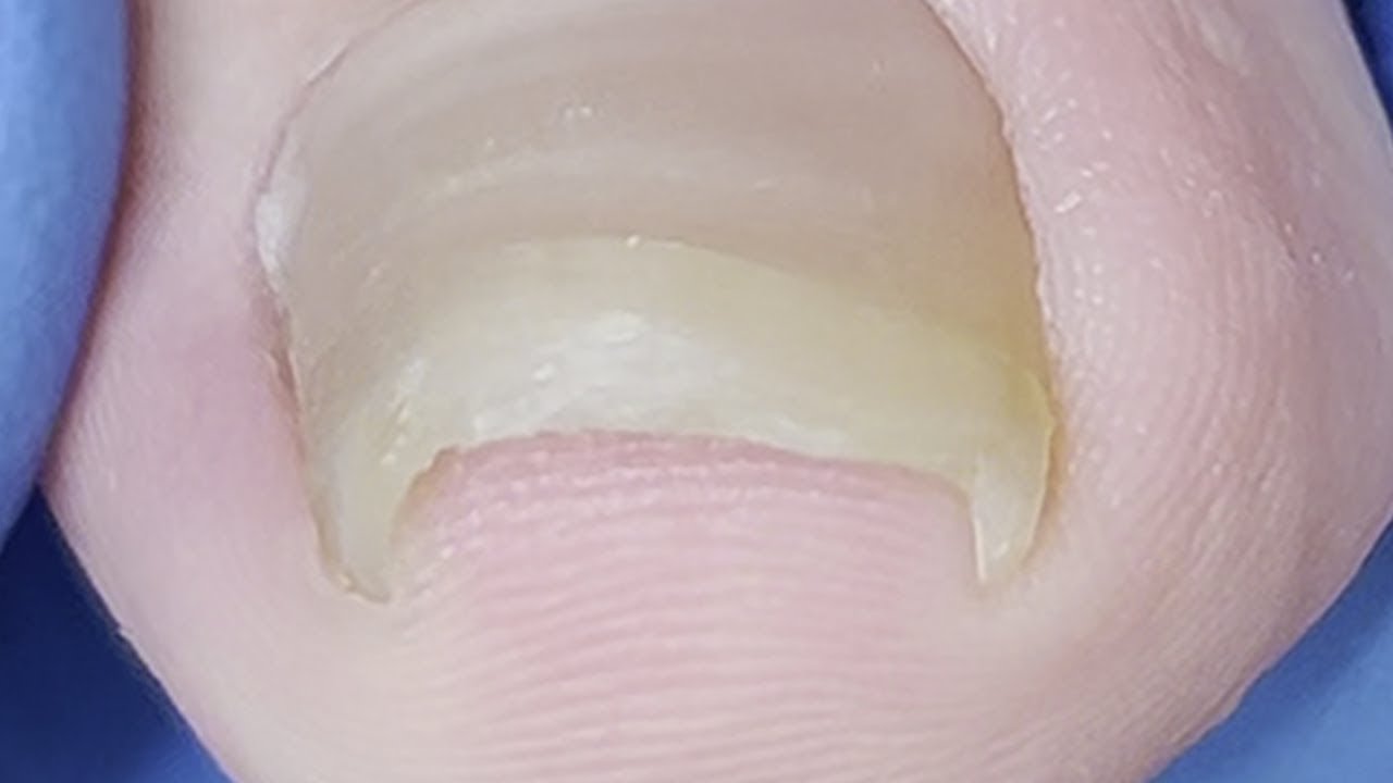 Amazing toenails! Downward growth is very curly【Xue Yidao Pedicure ...