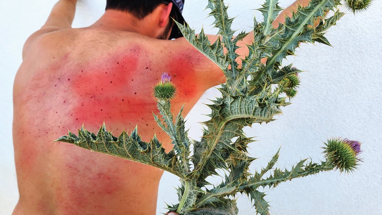 The WORST Thistle injury on the internet. - YouTube