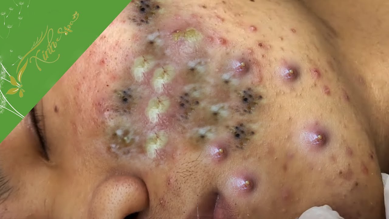 Relax Every Day with Xinh Spa Acne Treatment 8#200 - YouTube