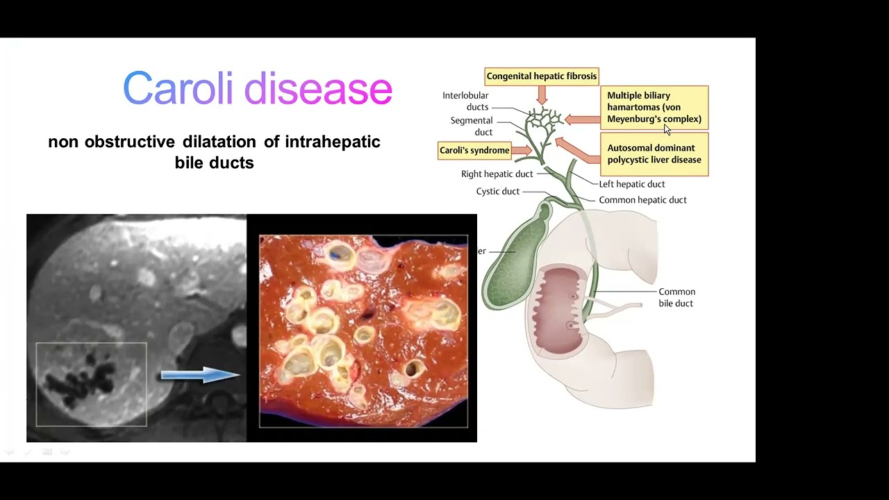 Caroli disease - YouTube