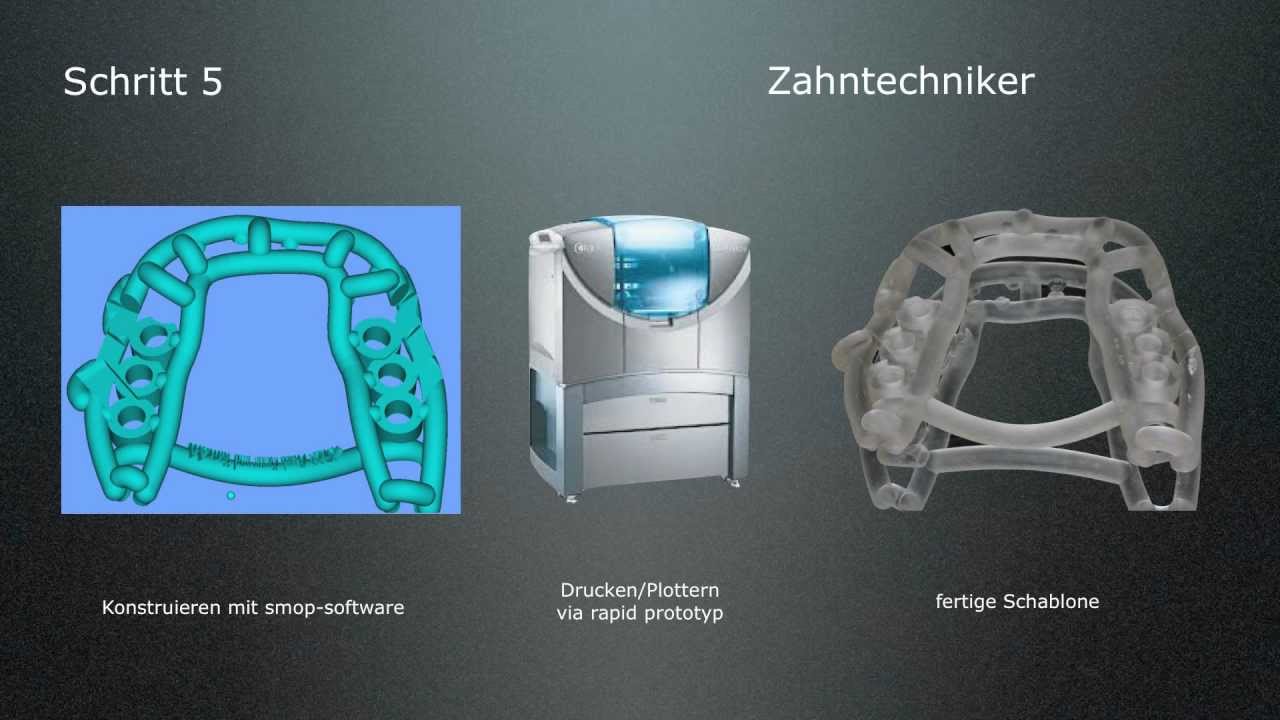 3D Online-Implantat-Planung mit SMOP (F-Kurs) - YouTube