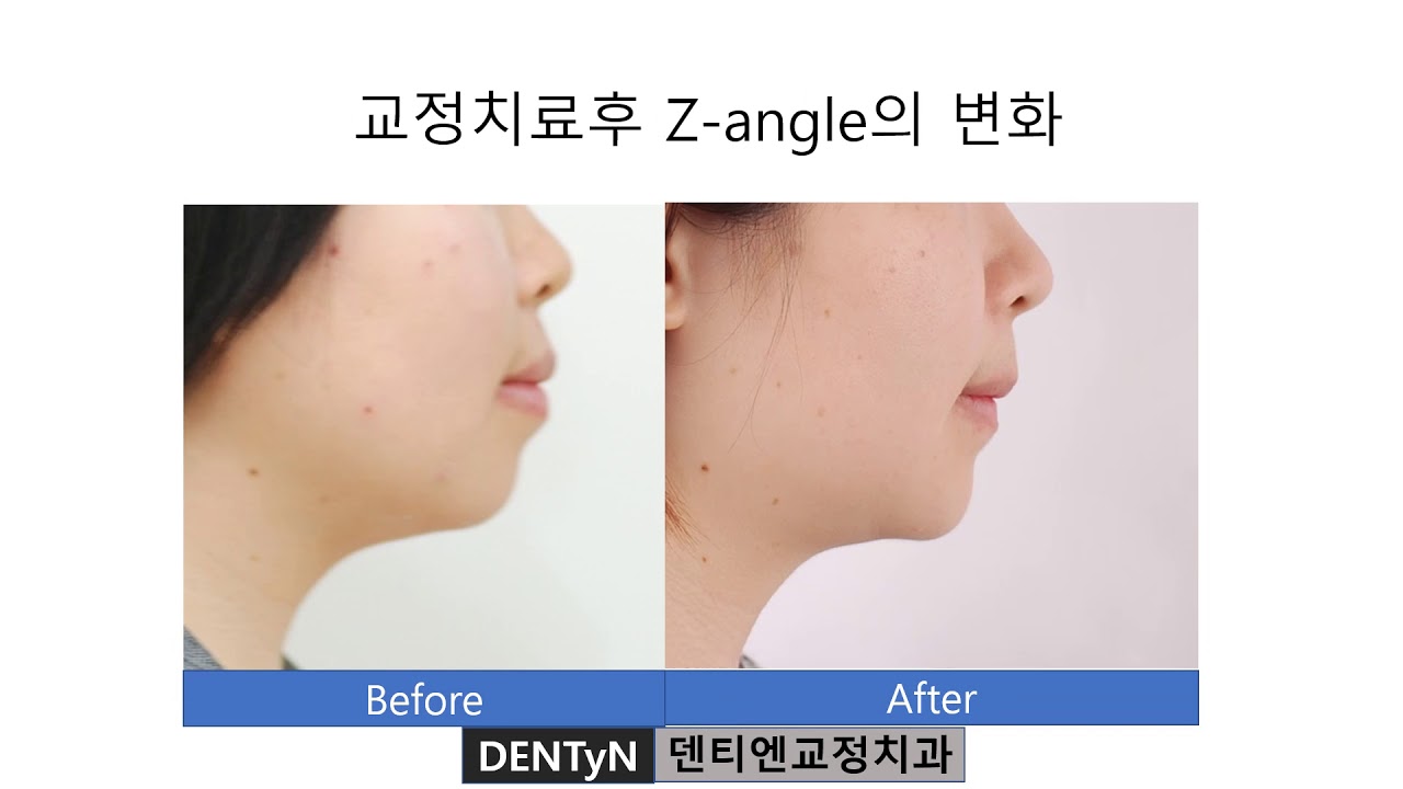 교정치료후 Z angle의 변화 - YouTube