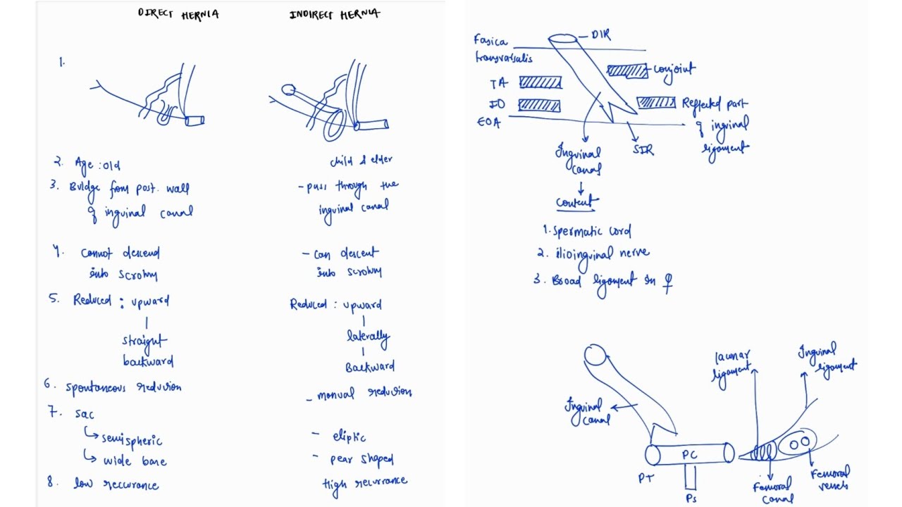 DIRECT VS INDIRECT INGUINAL HERNIA NOTES | ONE PAGE NOTE |HERNIA ...