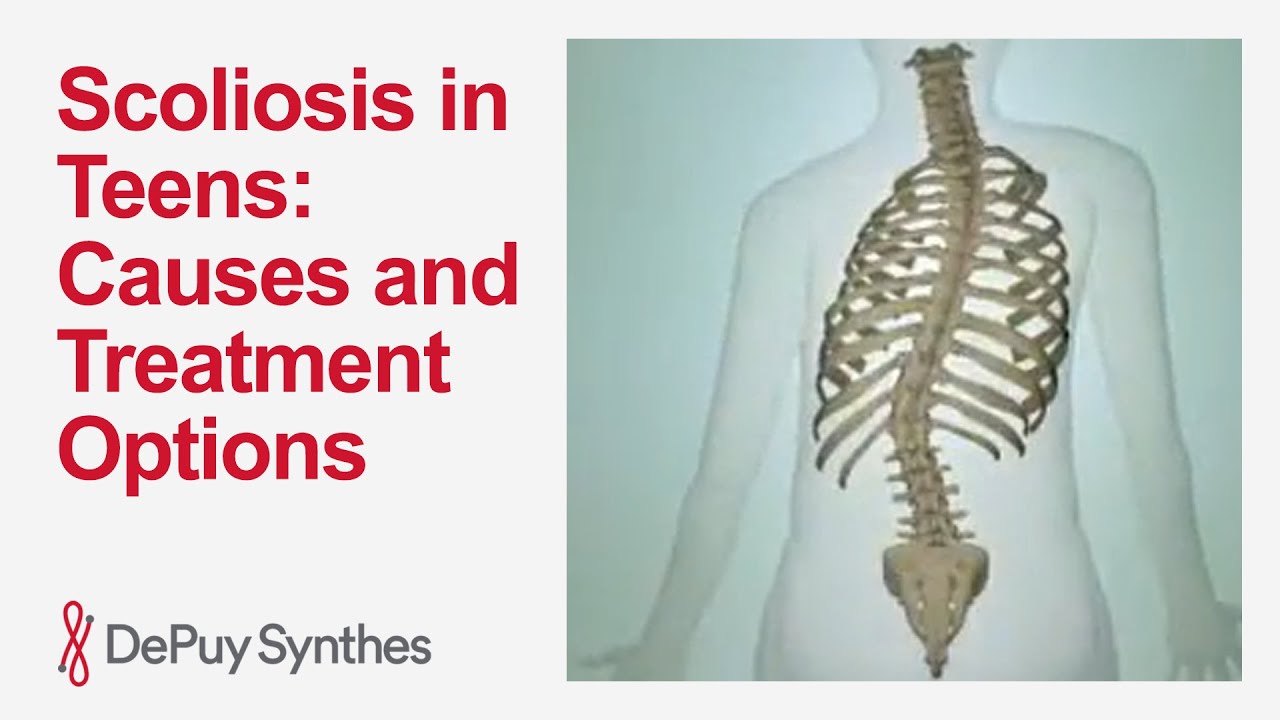 Teen Scoliosis: Early Signs, Causes, and Treatment Options Explained ...