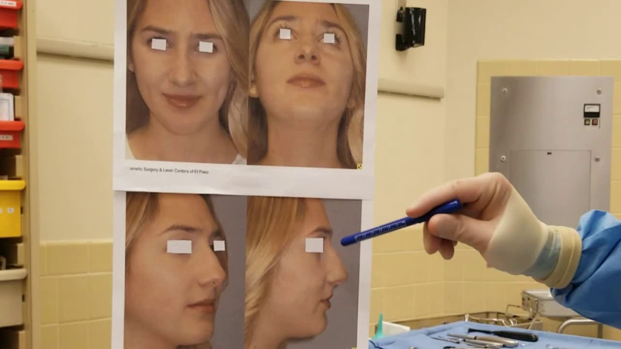 Rhinoplasty | El Paso Cosmetic Surgery - YouTube