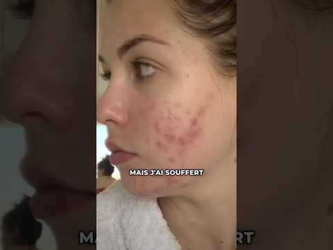 J'en ai pas fini avec l'acné… 😐