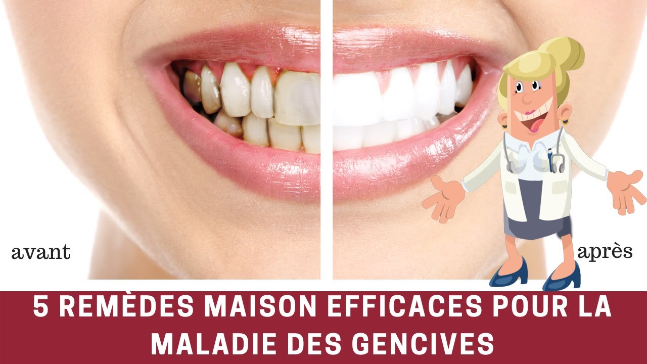 Maladie Des Gencives - 5 remèdes maison efficaces pour la maladie des ...