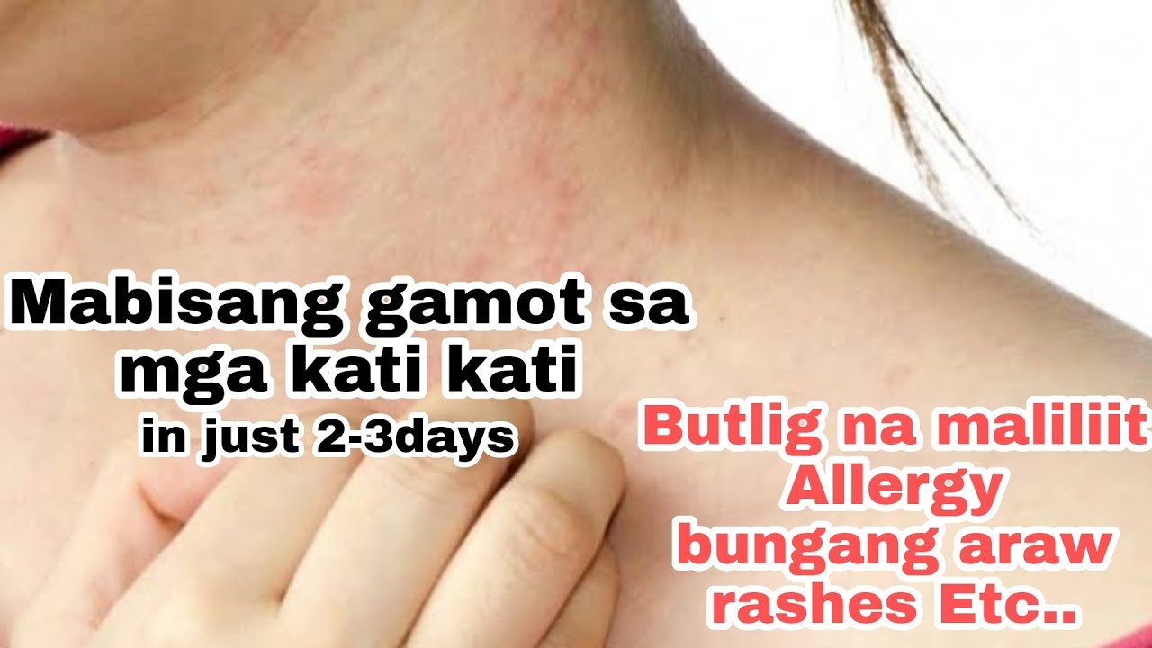 Tips para mabilis mawala ang rashes or allergy in just 2-3days - YouTube