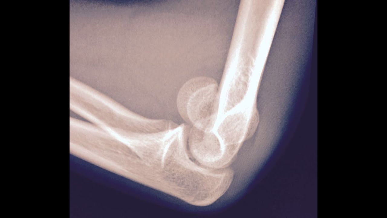 Cannulated cancellous screw fixation for capitellum fractures in ...
