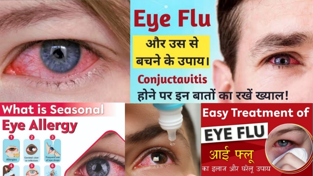 Conjunctivitis / Eye Flu Causes, Symptoms ,Treatment | eye flu के घरेलू ...