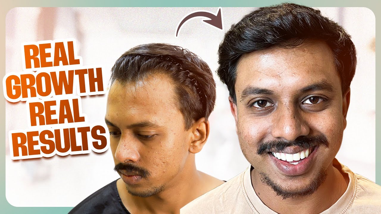 The Art of Hairline Perfection 😍 | Hair Transplant in Vashi | New Roots ...