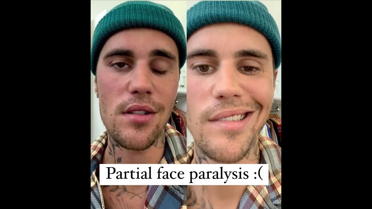 Justin Beiber's right side of his face gets paralyzed after a virus ...