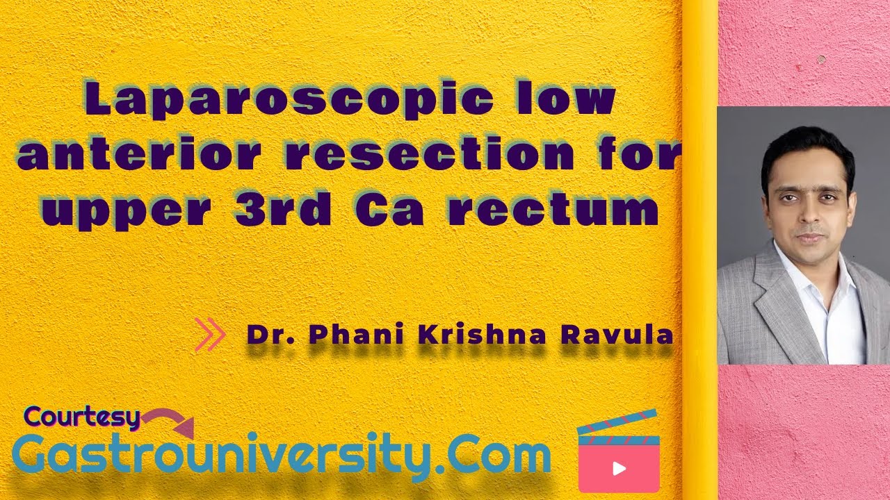 Rectum-Laparoscopic low anterior resection for upper 3rd Ca rectum ...
