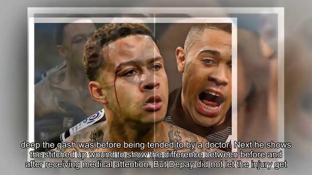 Memphis Depay shows off gruesome eye gash being stitched after Lyon’s ...