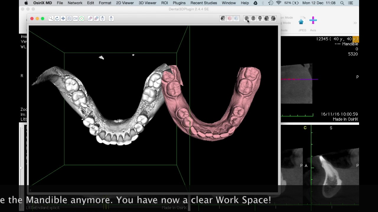 How to Separate the Maxilla and the Mandible of your CT-Scan with ...