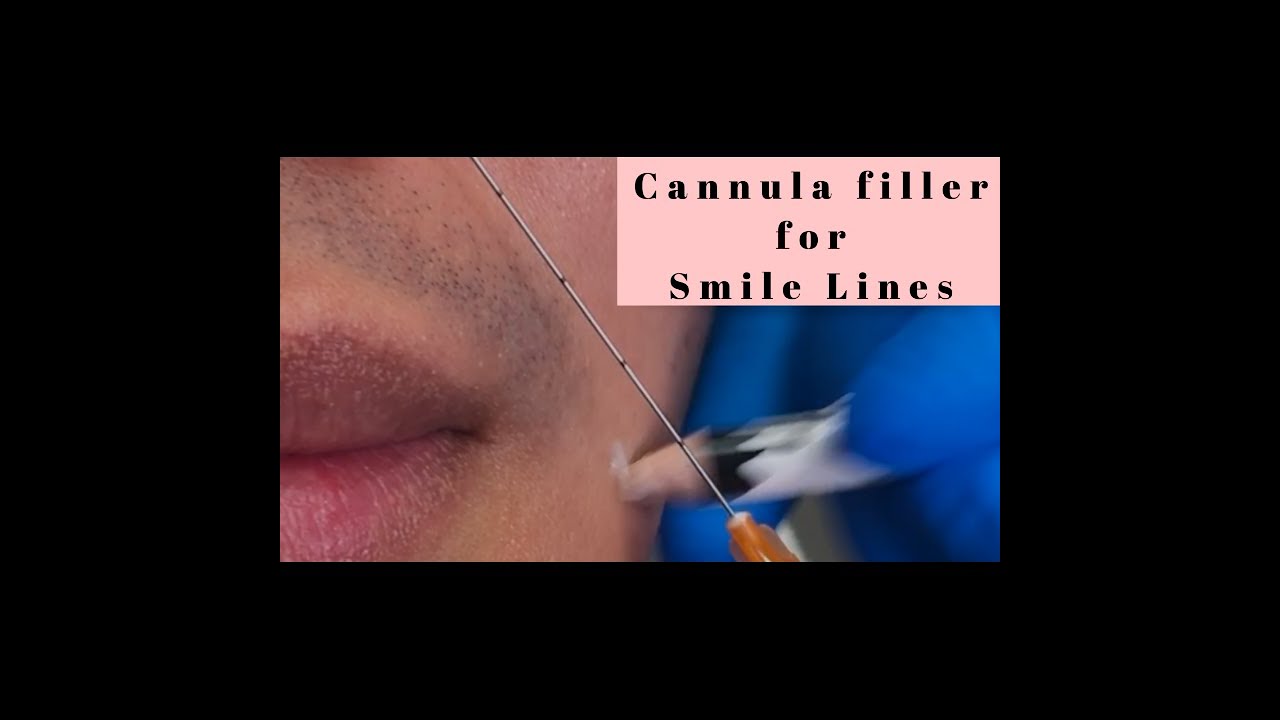 Cannula filler smile lines - YouTube