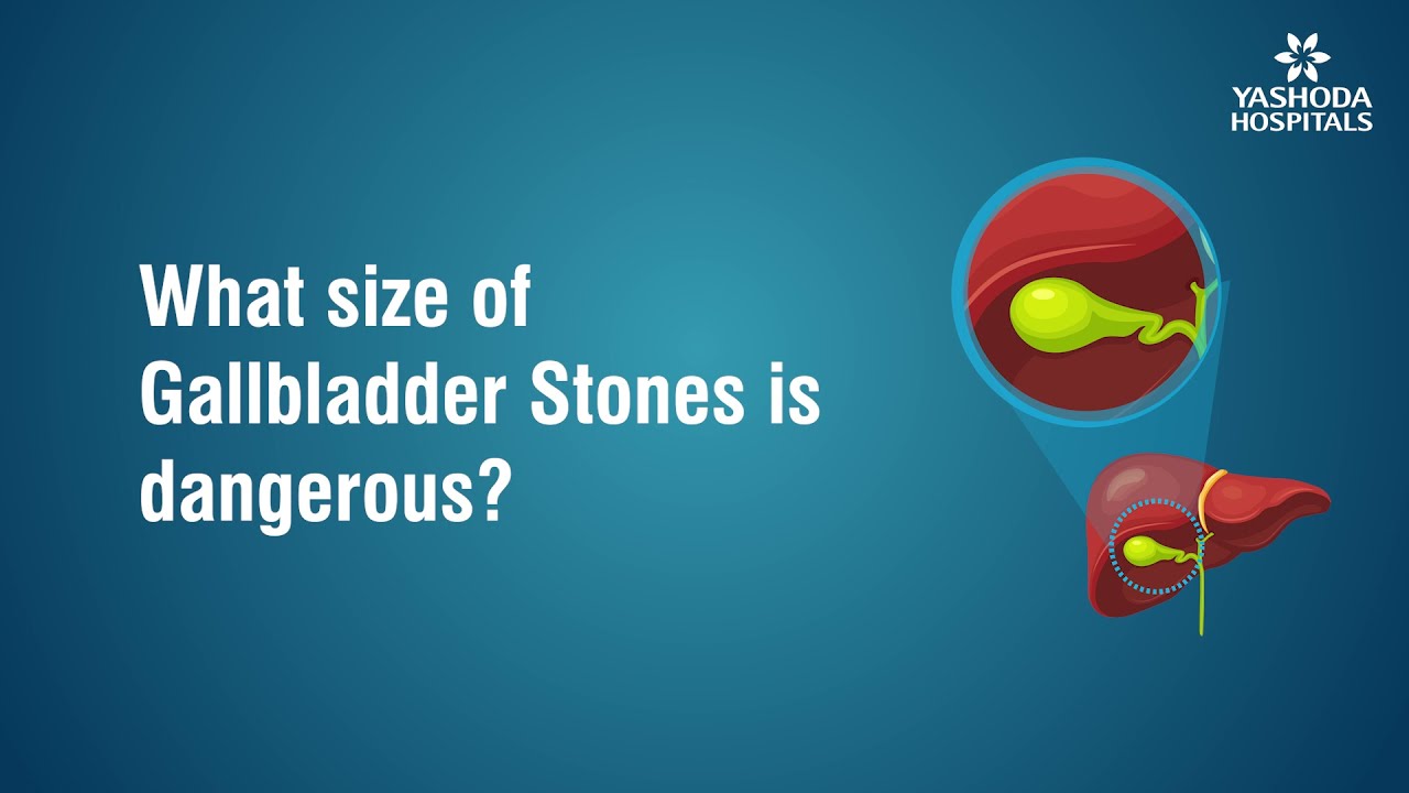 What Size Of Gallbladder Stone Is Dangerous YouTube What Size Of Gallbladder Stone Is Dangerous YouTube