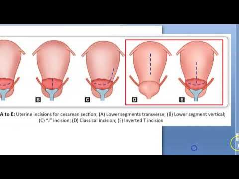 Obstetrics 692 Types of caesarean section csection LSCS Vs classical lower segment benefits when ...